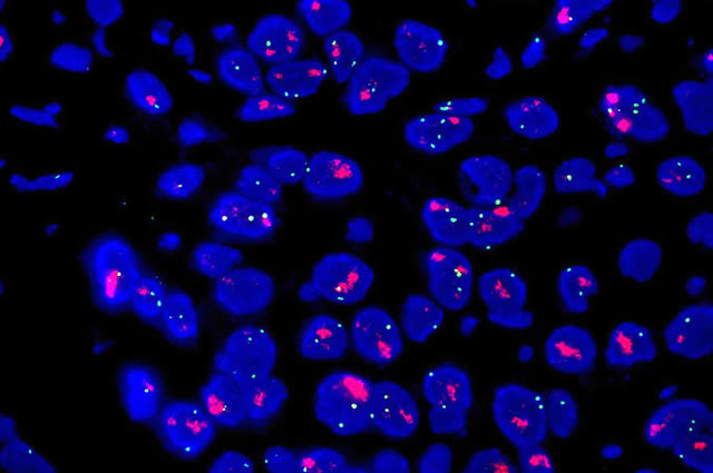 技术赋能 精准医疗——病理科成功开展乳腺癌HER2 FISH检测 - 南方科技大学医院
